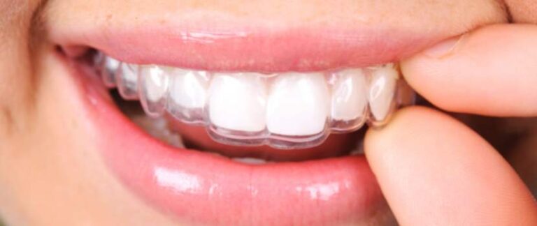 ¿Qué son y cuales retenedores dentales son los mejores?